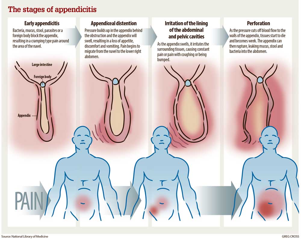 Should you have your appendix removed? | The Bulletin